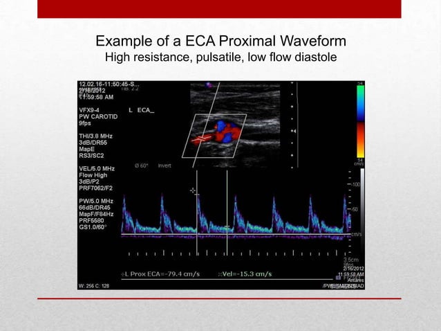 Qi carotid study 5 10-12 -cme | PPT