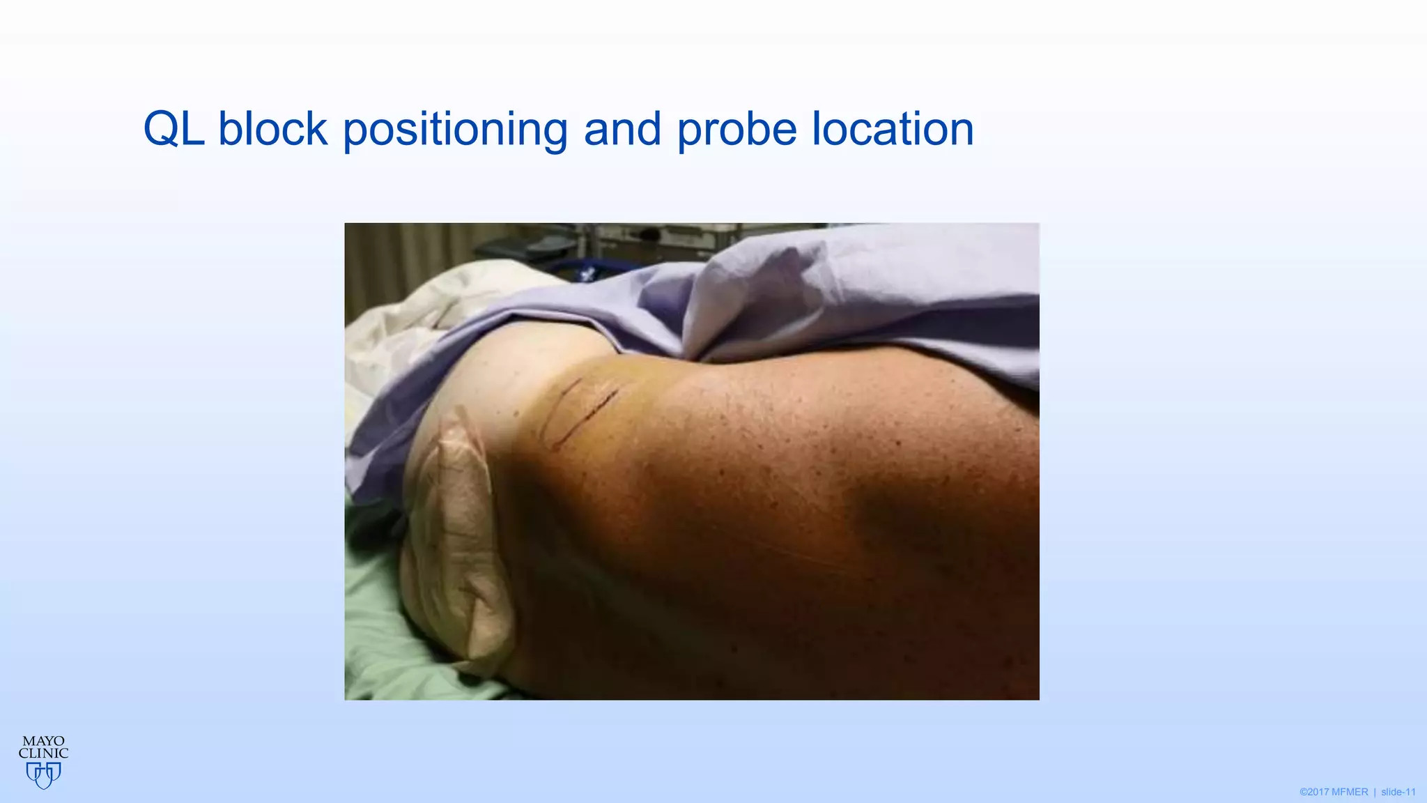 Quadratus Lumborum Block - Dr. V Koyyalamudi | PPTX