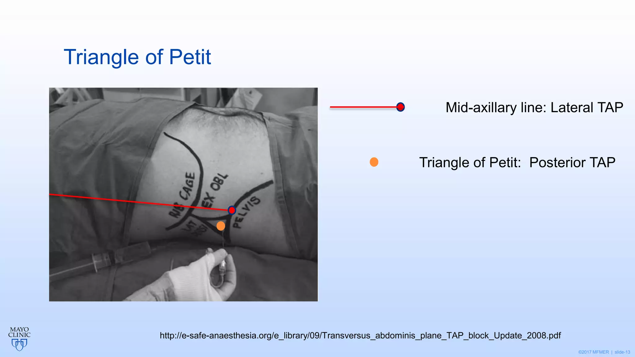 Quadratus Lumborum Block - Dr. V Koyyalamudi | PPTX