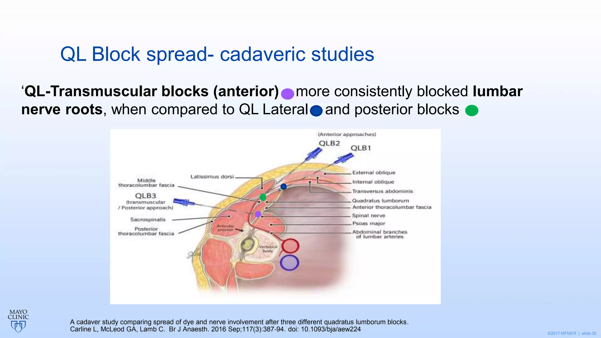 Quadratus Lumborum Block - Dr. V Koyyalamudi | PPTX
