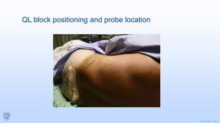 Quadratus Lumborum Block - Dr. V Koyyalamudi | PPTX