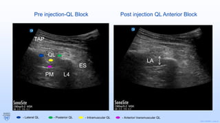 Quadratus Lumborum Block - Dr. V Koyyalamudi | PPTX