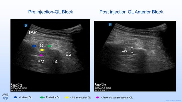 Quadratus Lumborum Block - Dr. V Koyyalamudi | PPTX