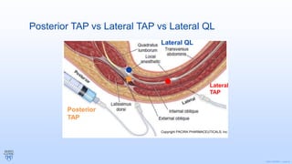 Quadratus Lumborum Block - Dr. V Koyyalamudi | PPTX