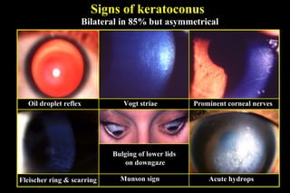 18 corneal ectasias | PPT