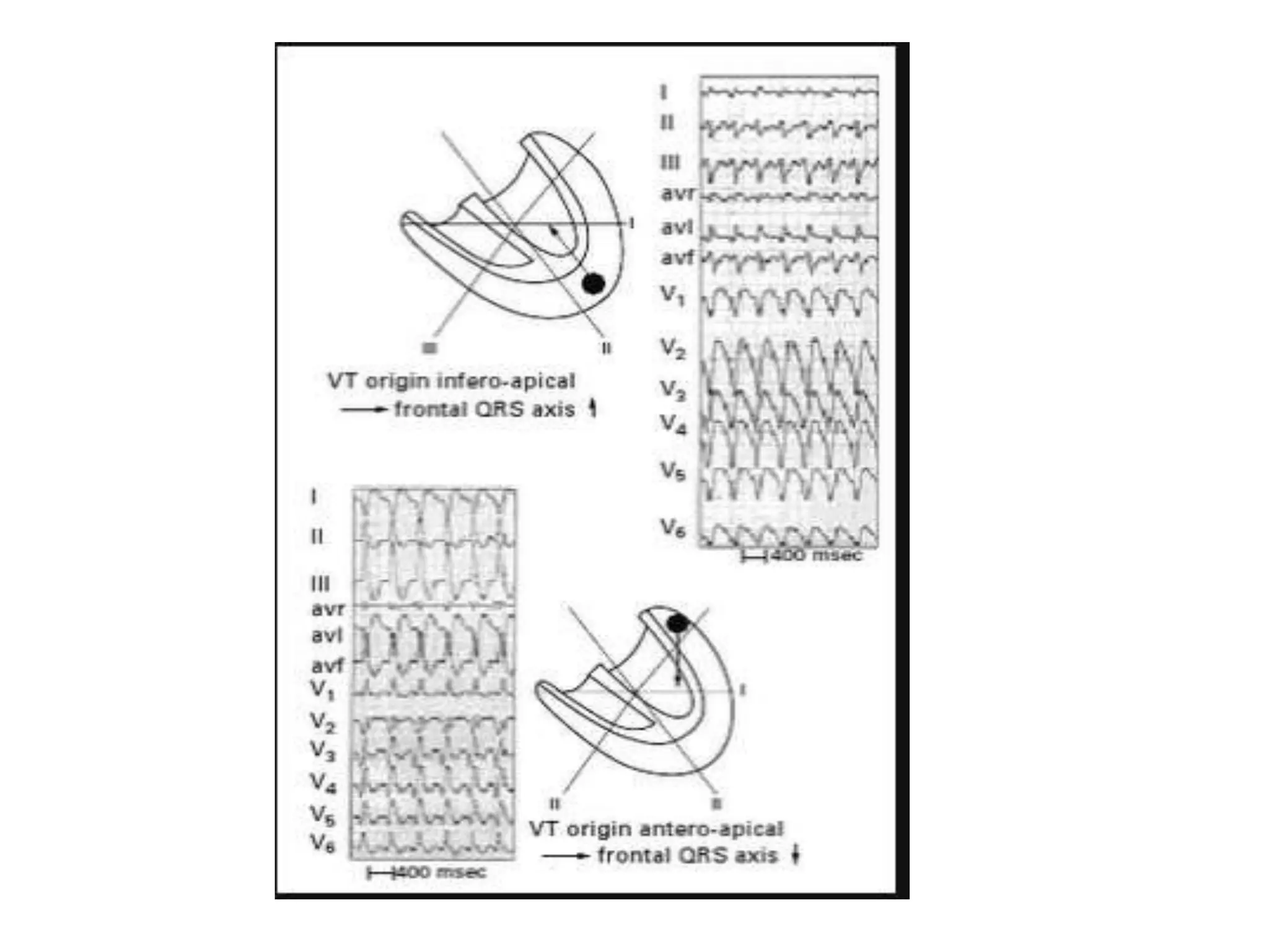 QRS axis change during ventricualr tachycardia (VT) | PPT