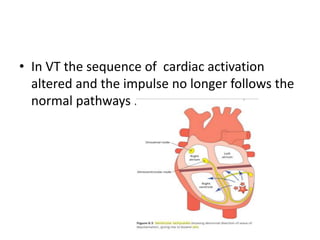 QRS axis change during ventricualr tachycardia (VT) | PPT