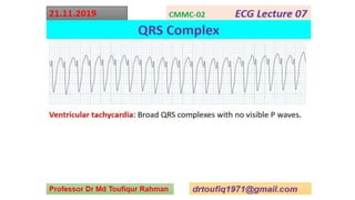 ECG -QRS complex | PPTX