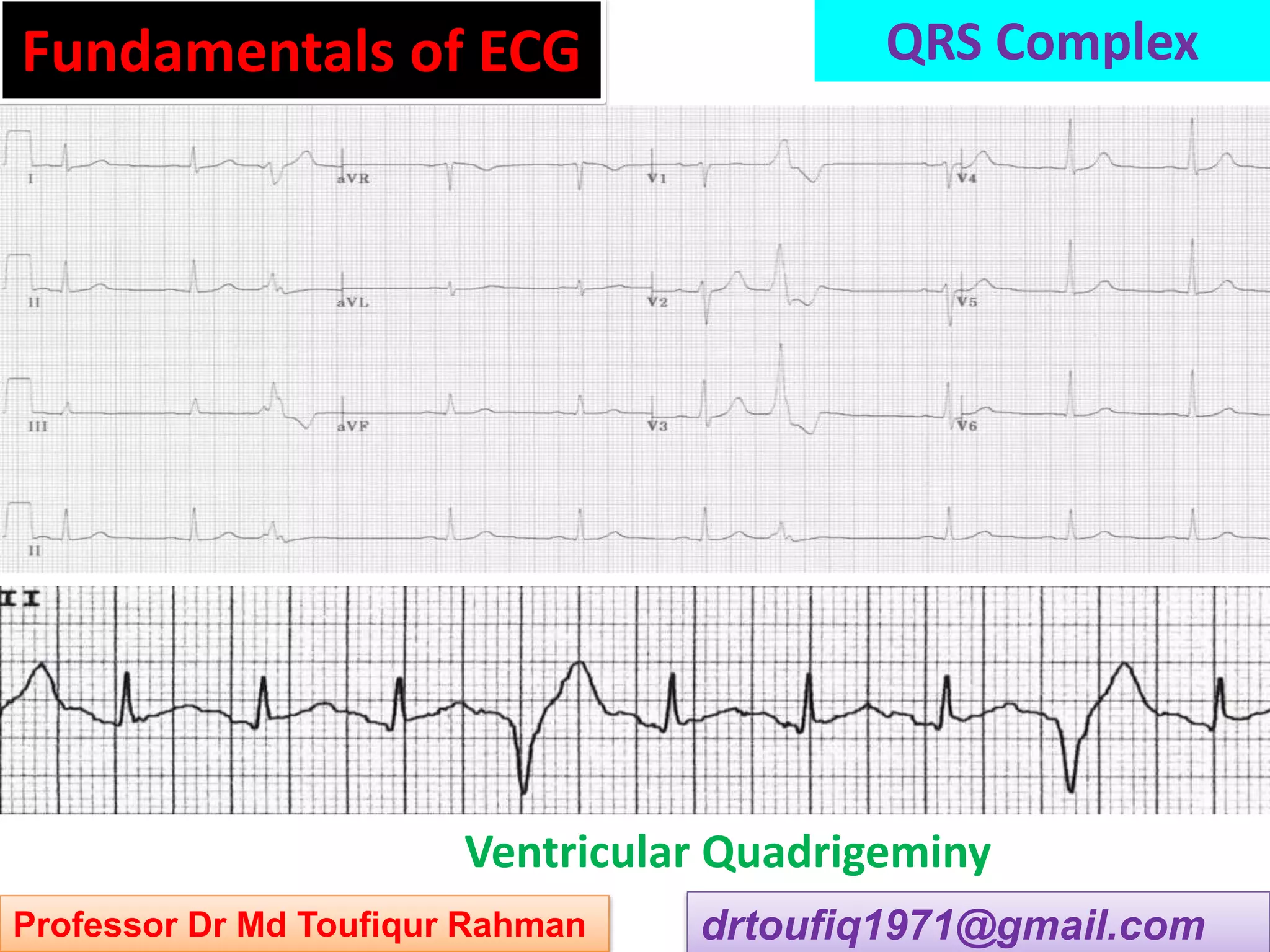 Approach to a patient with QRS complex abnormality in ECG | PPT