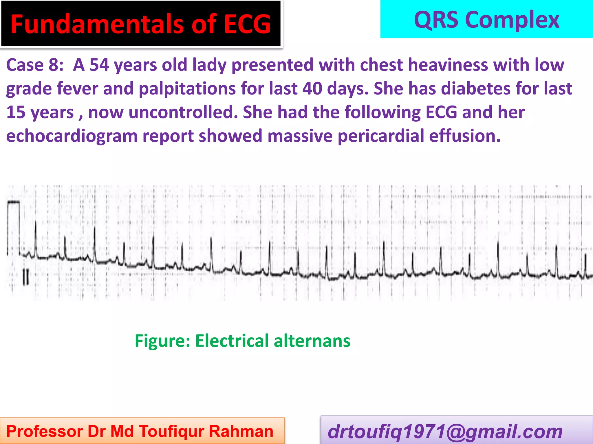 Approach to a patient with QRS complex abnormality in ECG | PPT