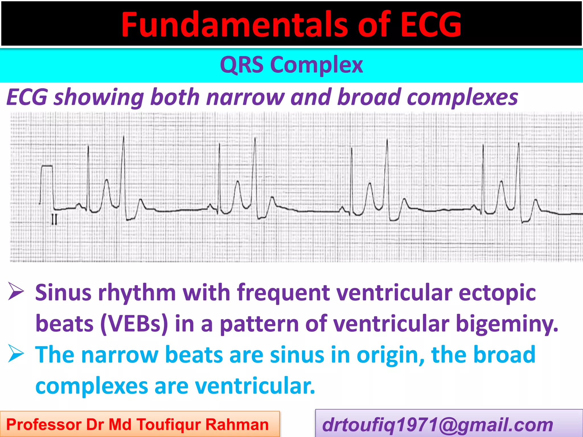 Approach To A Patient With Qrs Complex Abnormality In Ecg Ppt