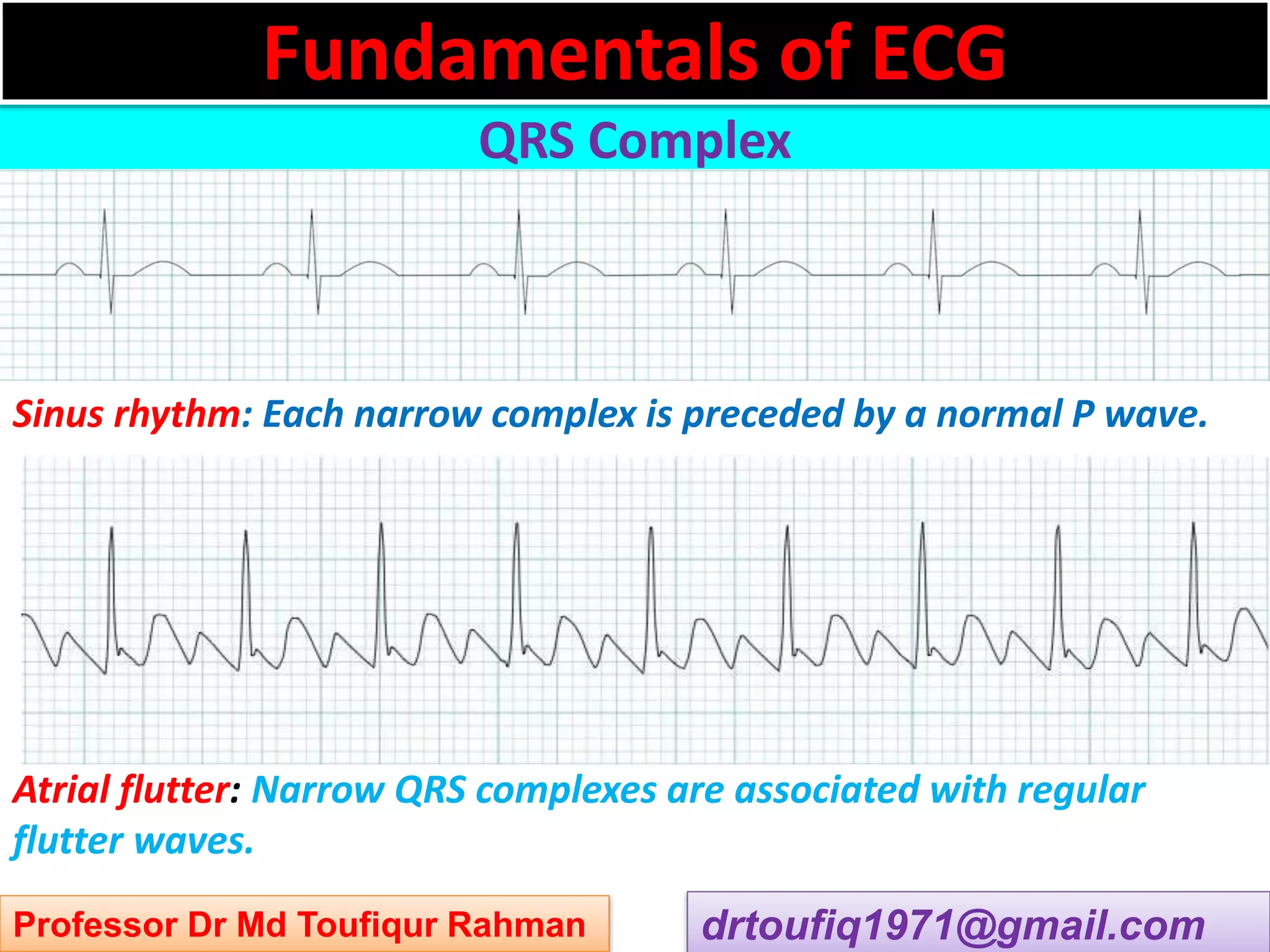 Approach to a patient with QRS complex abnormality in ECG | PPT