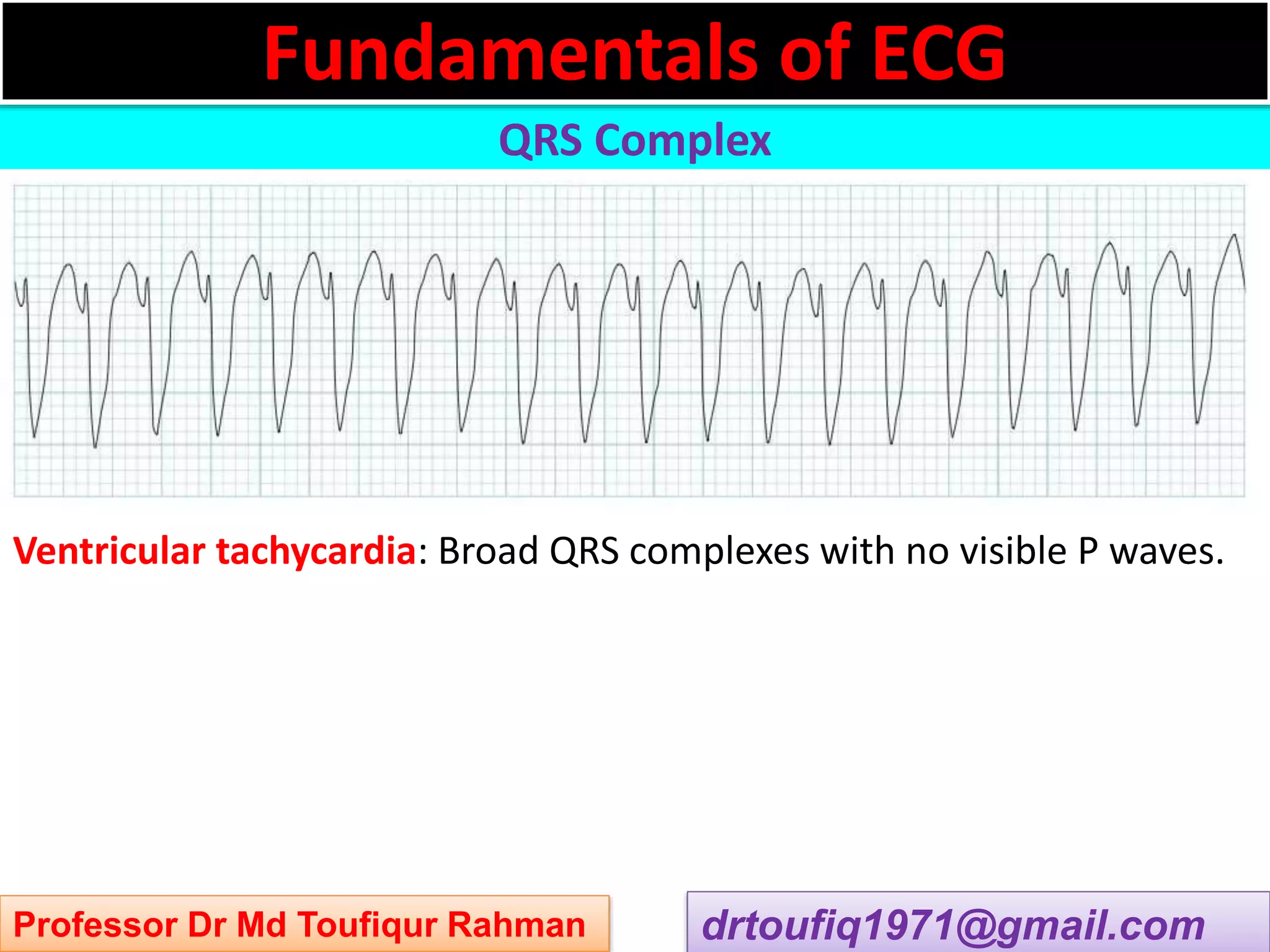 Approach to a patient with QRS complex abnormality in ECG | PPT
