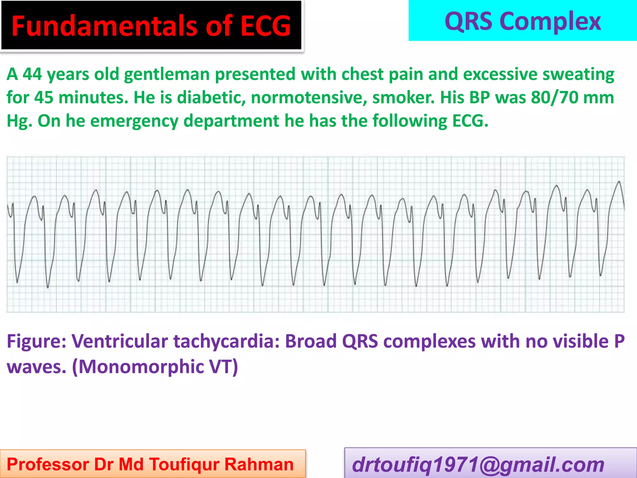 Approach To A Patient With Qrs Complex Abnormality In Ecg Ppt