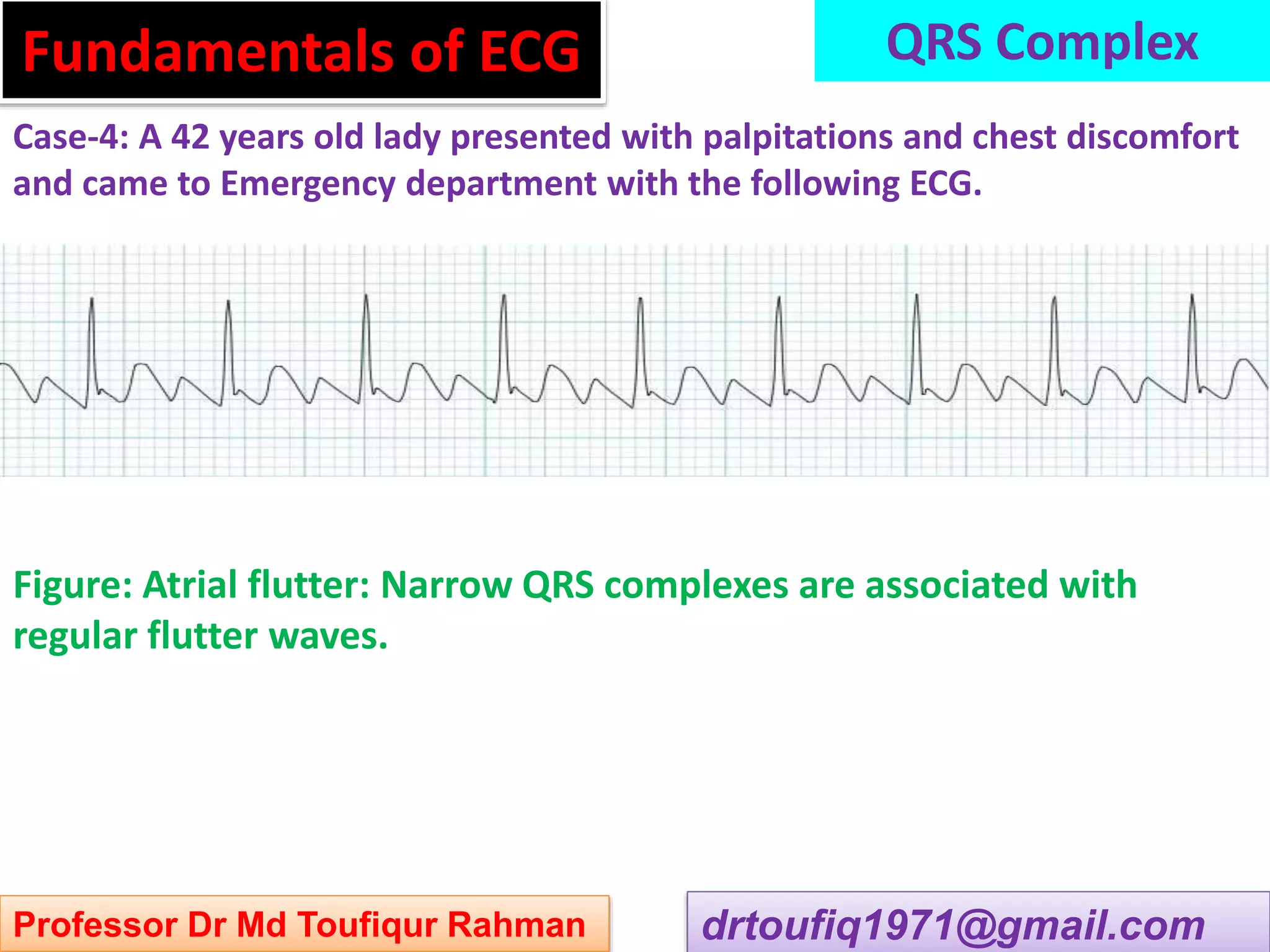 Approach To A Patient With Qrs Complex Abnormality In Ecg Ppt