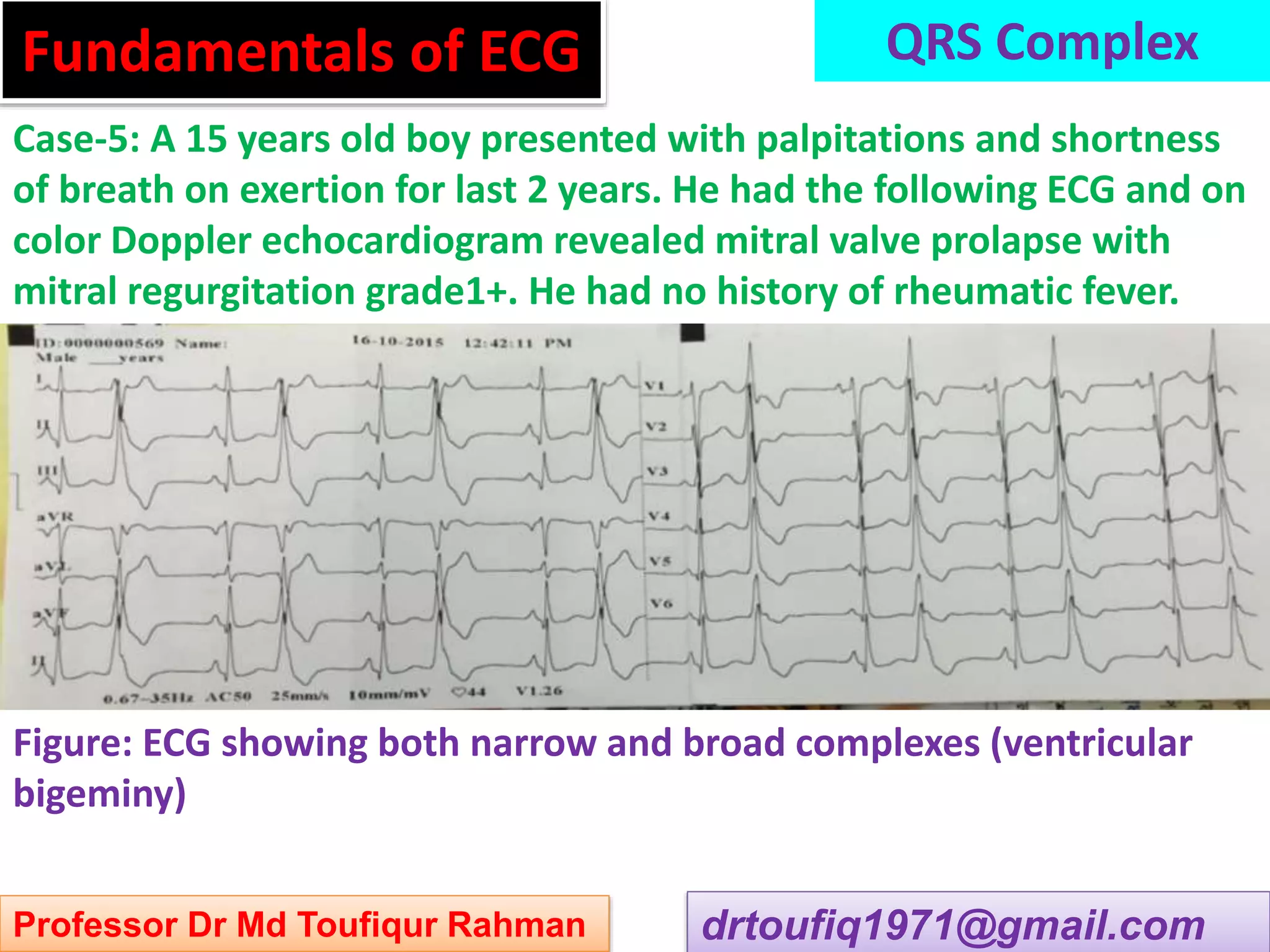 Approach To A Patient With Qrs Complex Abnormality In Ecg Ppt