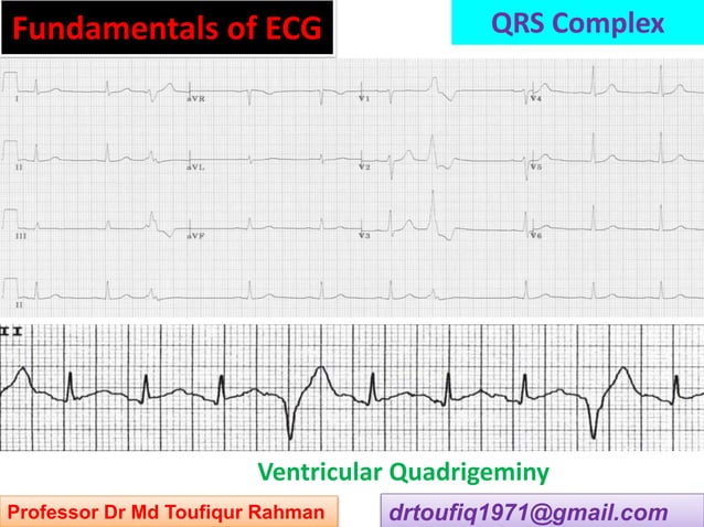 Approach To A Patient With Qrs Complex Abnormality In Ecg Ppt