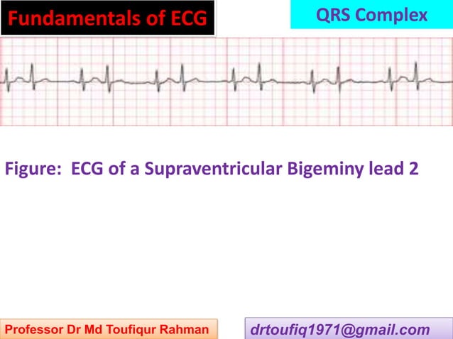 Approach to a patient with QRS complex abnormality in ECG | PPT