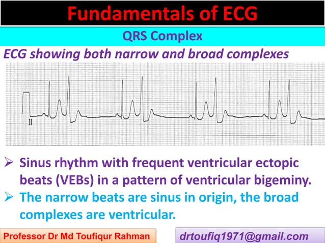 Approach to a patient with QRS complex abnormality in ECG | PPT