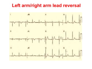 QRS INTERVAL IN ECG AND ITS ABNORMALITIES | PPTX