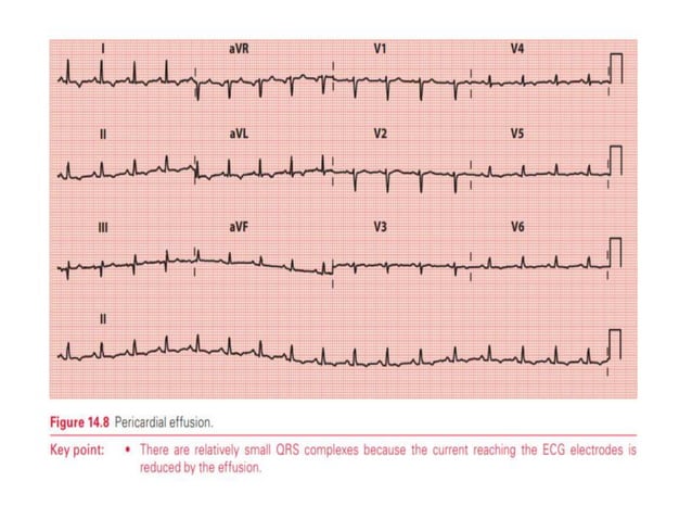 QRS INTERVAL IN ECG AND ITS ABNORMALITIES | PPTX