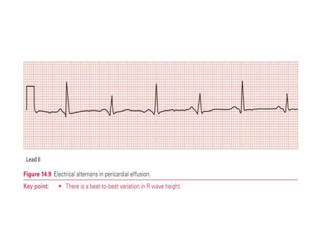 QRS INTERVAL IN ECG AND ITS ABNORMALITIES | PPTX