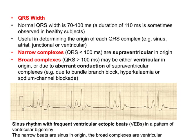 QRS INTERVAL IN ECG AND ITS ABNORMALITIES | PPTX