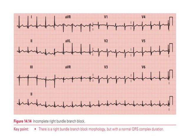 QRS INTERVAL IN ECG AND ITS ABNORMALITIES | PPTX
