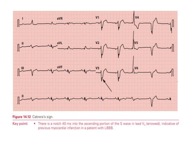 QRS INTERVAL IN ECG AND ITS ABNORMALITIES | PPTX