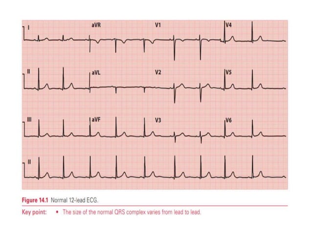 QRS INTERVAL IN ECG AND ITS ABNORMALITIES | PPTX