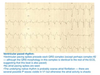 QRS INTERVAL IN ECG AND ITS ABNORMALITIES | PPTX