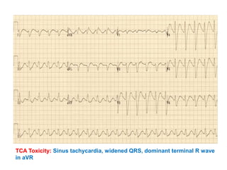 QRS INTERVAL IN ECG AND ITS ABNORMALITIES | PPTX