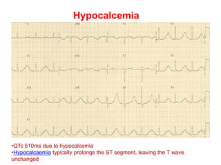 QT INTERVAL IN ECG,CAUSES OF SHORT AND LONG QT INTERVAL | PPTX