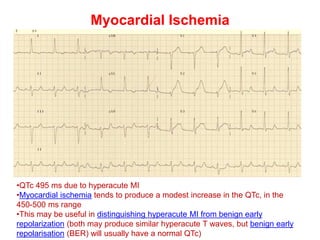 QT INTERVAL IN ECG,CAUSES OF SHORT AND LONG QT INTERVAL | PPTX