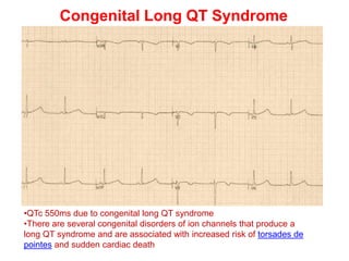 QT INTERVAL IN ECG,CAUSES OF SHORT AND LONG QT INTERVAL | PPT