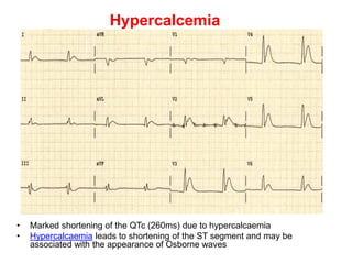 QT INTERVAL IN ECG,CAUSES OF SHORT AND LONG QT INTERVAL | PPTX