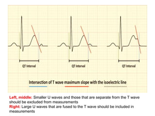 QT INTERVAL IN ECG,CAUSES OF SHORT AND LONG QT INTERVAL | PPTX