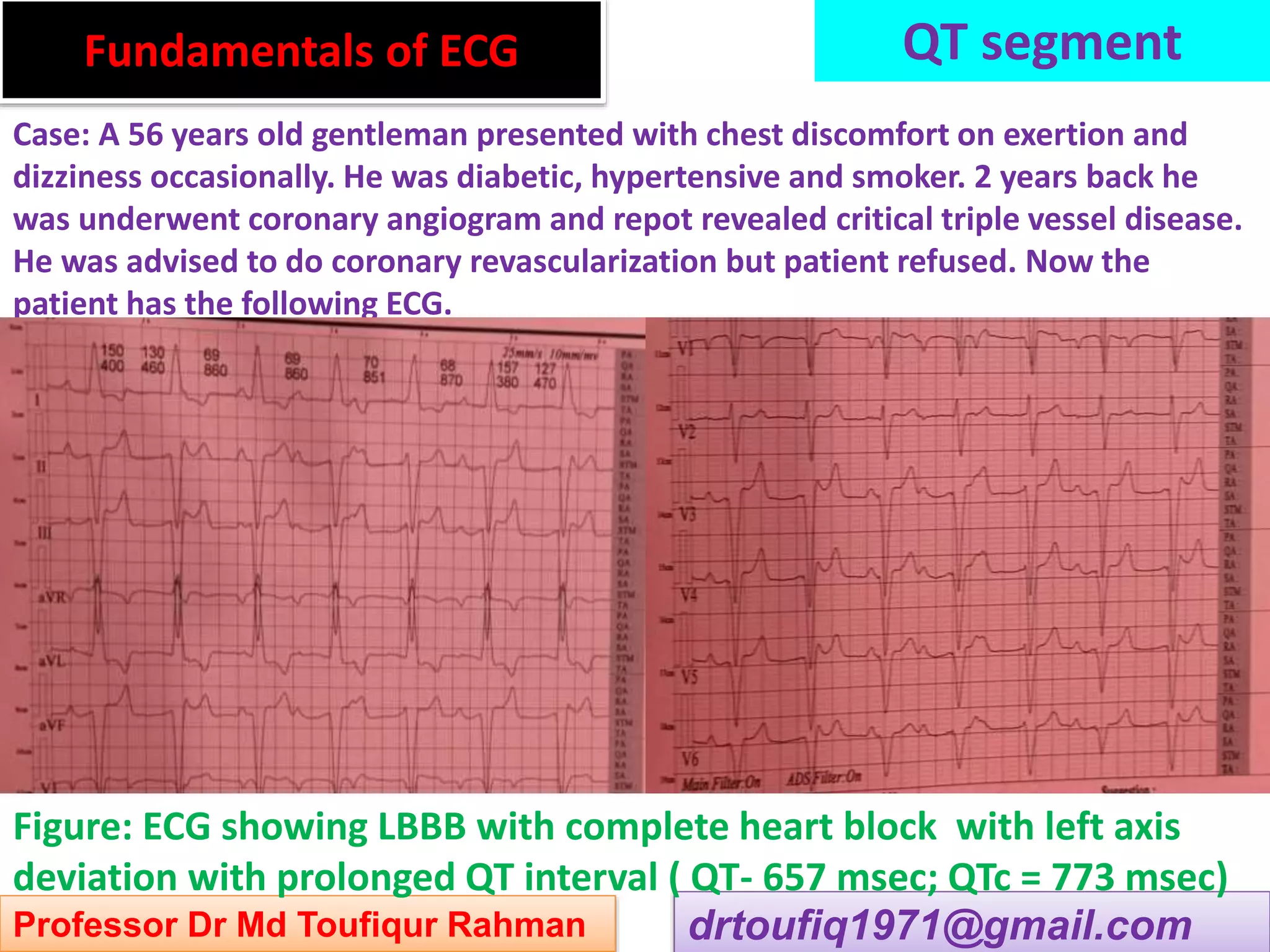 Approach to a patient with QTc interval abnormality in ECG | PPSX