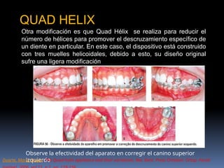 quad helix, caracteristicas, expansiones | PPTX