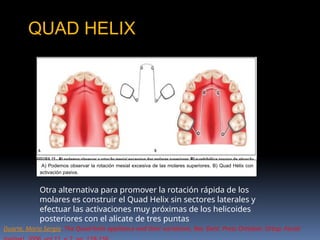 quad helix, caracteristicas, expansiones | PPTX