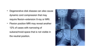 Quadriparesis of human beings due to compression.pptx