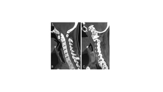 Quadriparesis of human beings due to compression.pptx