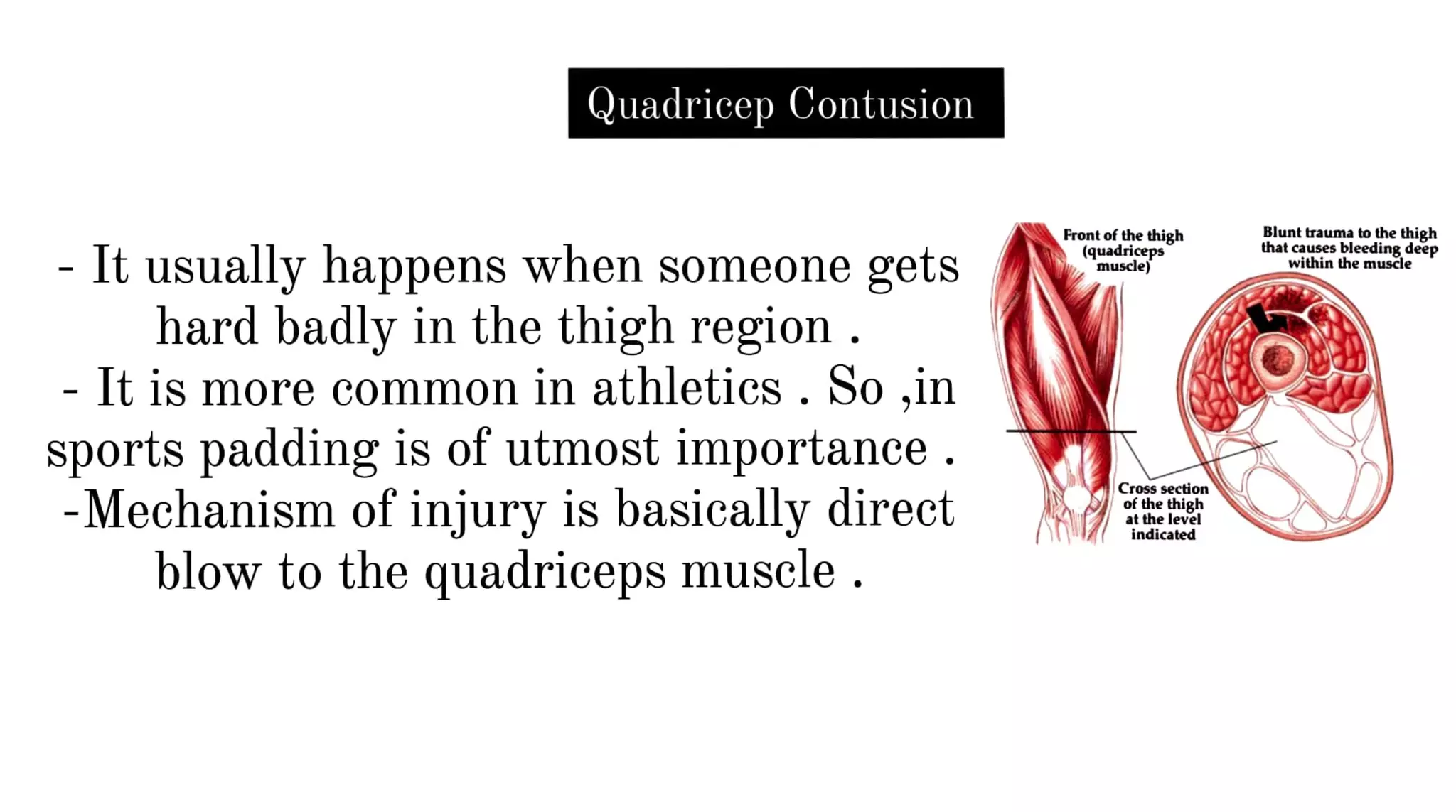 Quadricep Contusion.pdf