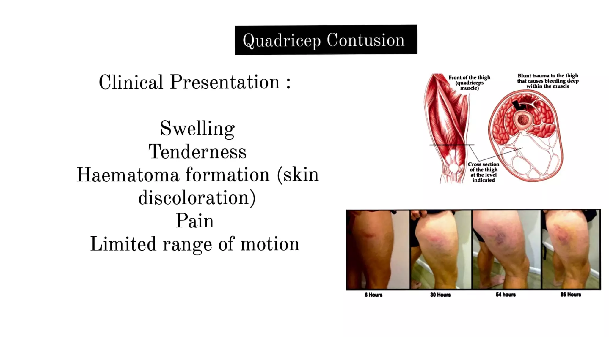 Quadricep Contusion.pdf