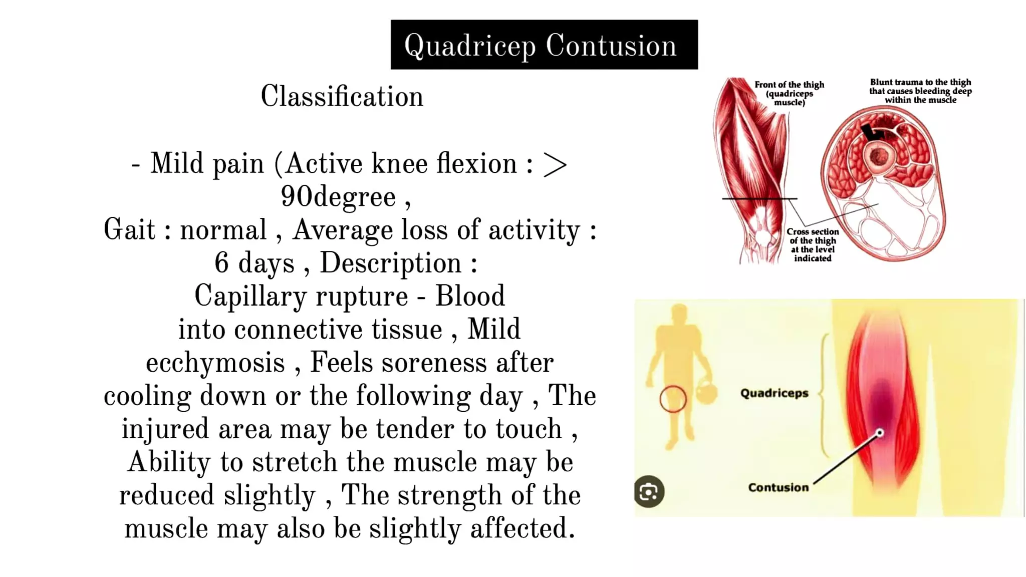 Quadricep Contusion.pdf