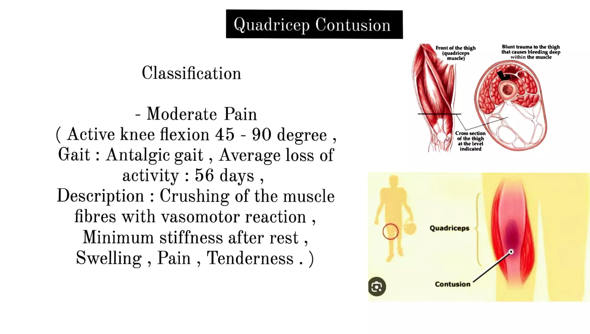 Quadricep Contusion.pdf