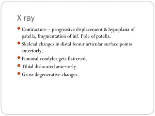 Quadriceps contracture | PPT