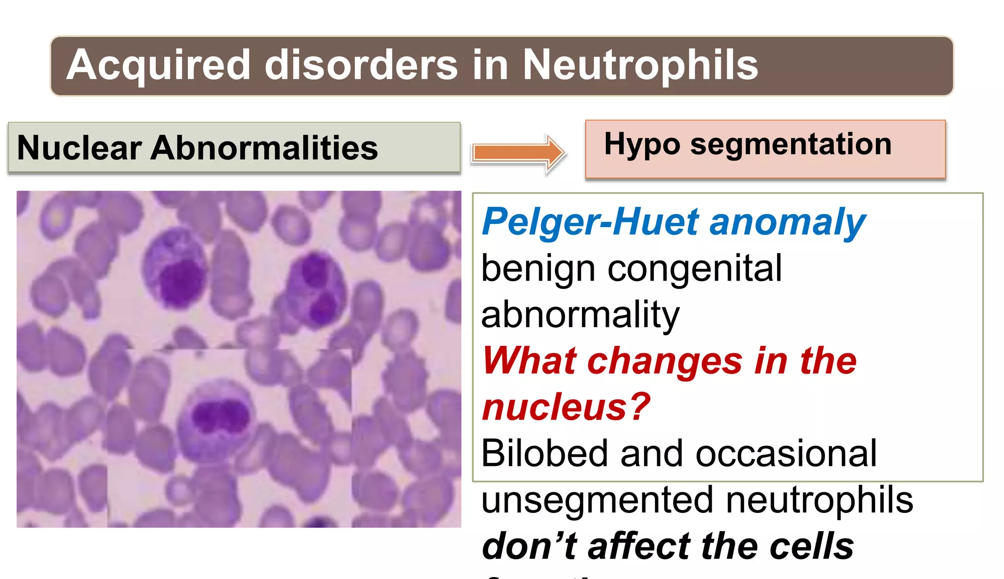 Qualitative defects of granular white cells.ppt