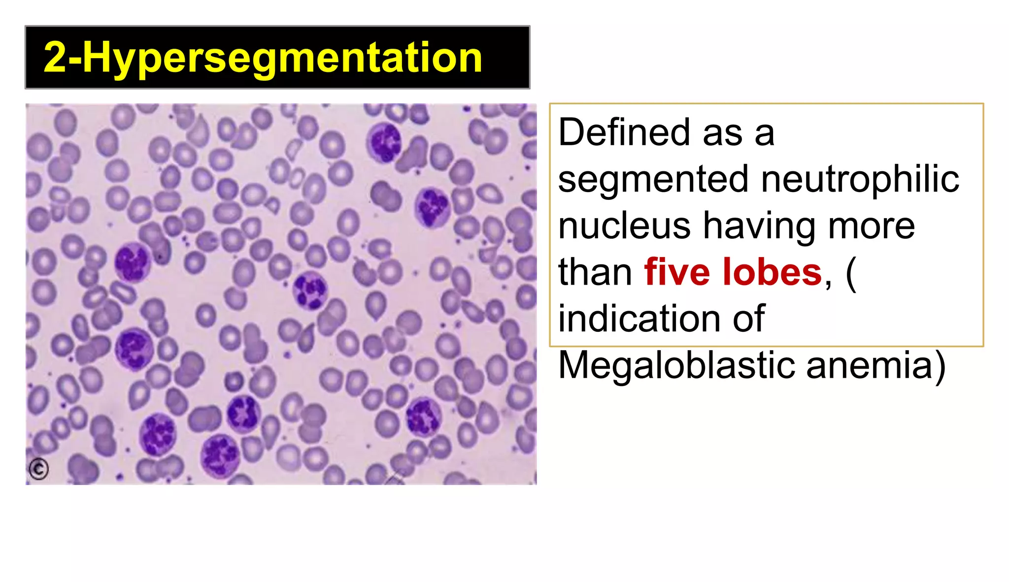 Qualitative defects of granular white cells.ppt