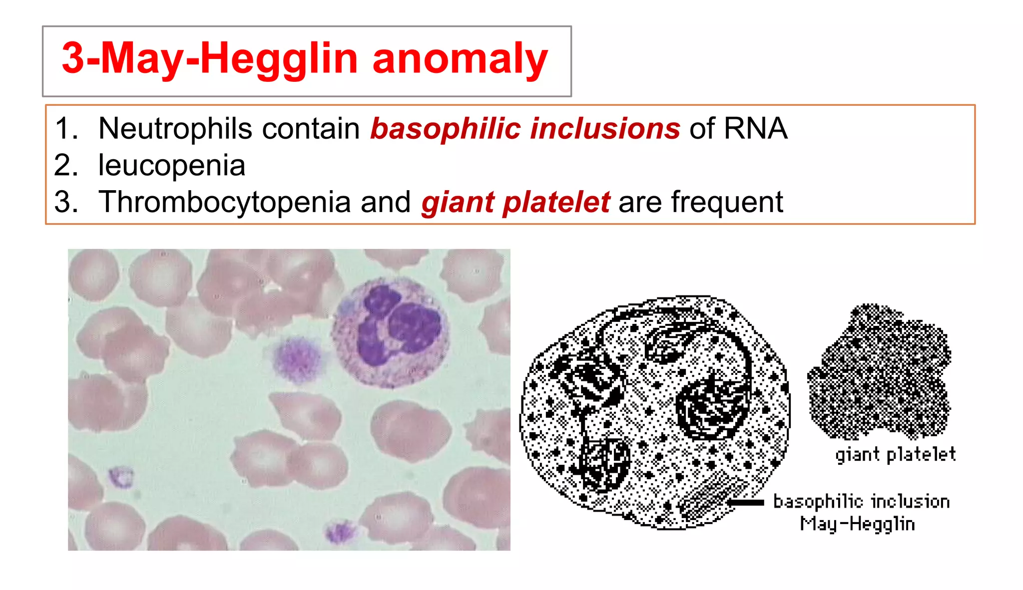 Qualitative defects of granular white cells.ppt